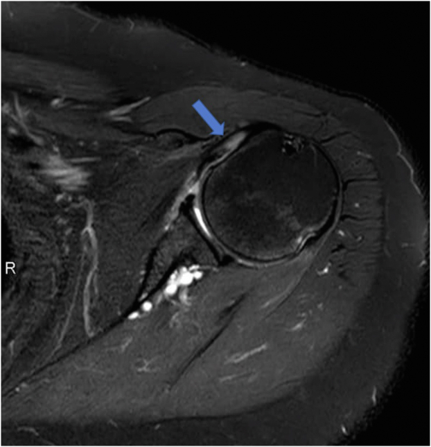 Arthroscopic Repair Of A High Grade Partial Articular Sided