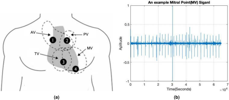 Multiscale analysis of heart sound signals in the wavelet domain for heart murmur detection - PMC