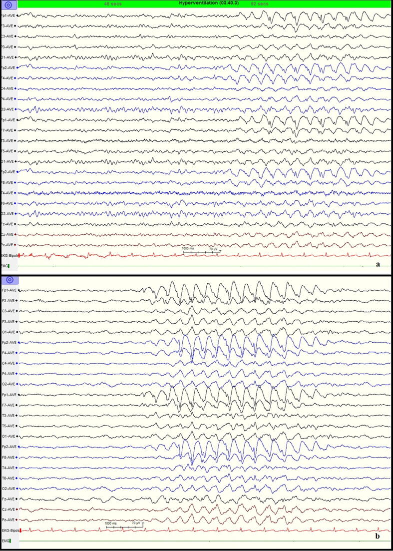 Weekly methotrexate may reduce valproate levels causing relapse of genetic generalized epilepsy ...
