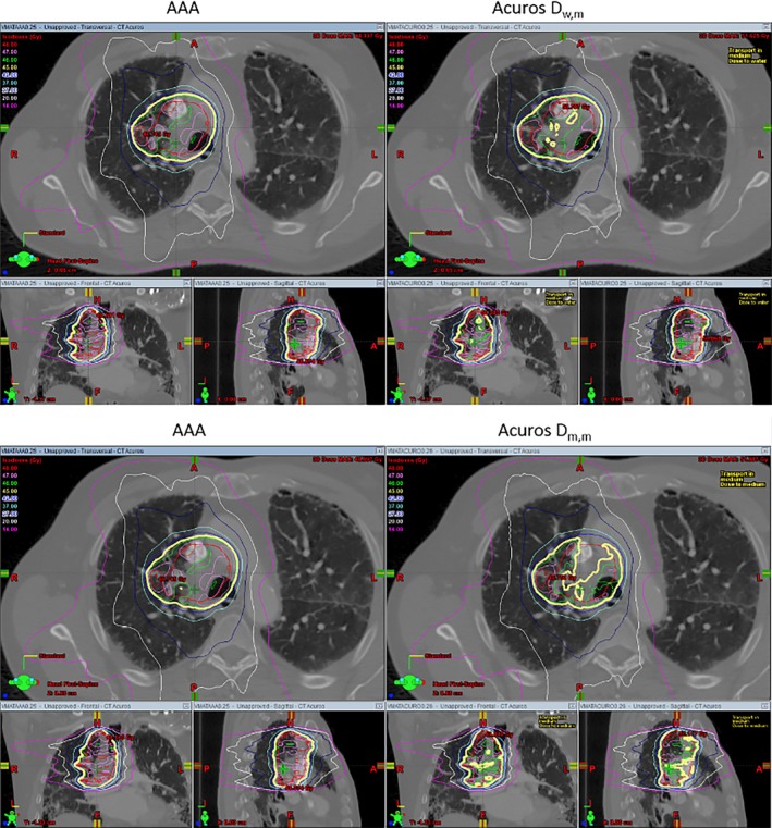 Clinical implementation and evaluation of the Acuros dose calculation algorithm - PMC