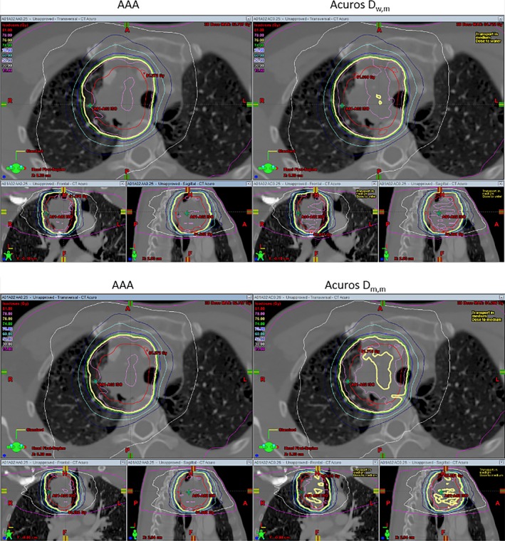 Clinical implementation and evaluation of the Acuros dose calculation algorithm - PMC