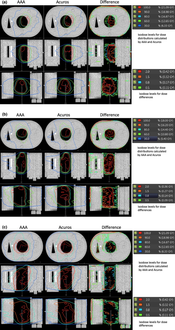 Clinical implementation and evaluation of the Acuros dose calculation algorithm - PMC