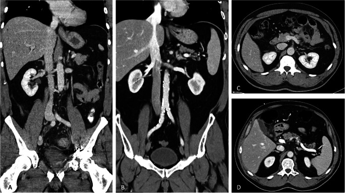 Initial Experience On Abdominal Photon Counting Computed Tomography In