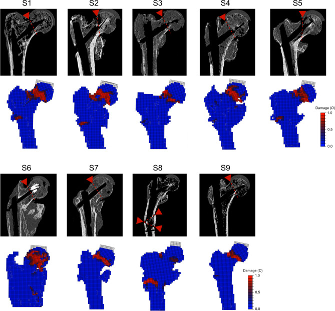 Femoral strength after cephalomedullary nail removal can be predicted preoperatively using CT ...