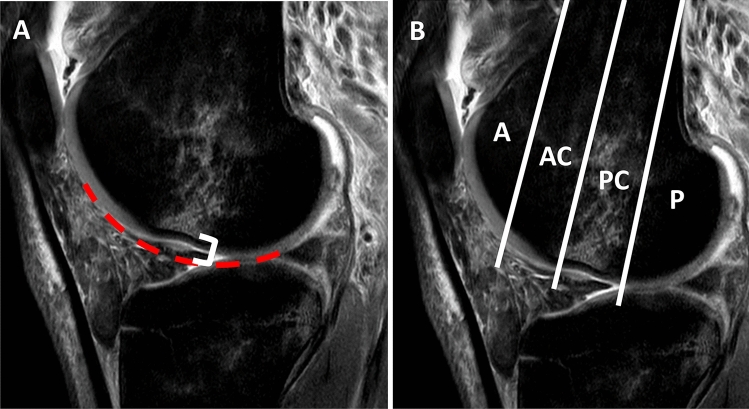 Lateral Femoral Notch Sign And Posterolateral Tibial Plateau Fractures And Their Associated