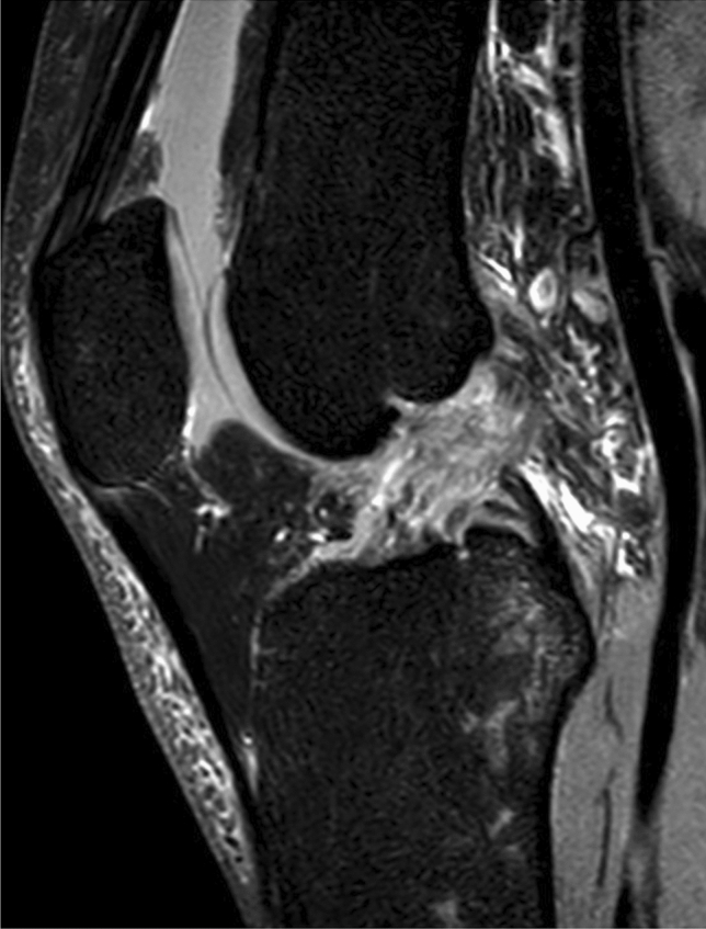 Lateral Femoral Notch Sign And Posterolateral Tibial Plateau Fractures And Their Associated