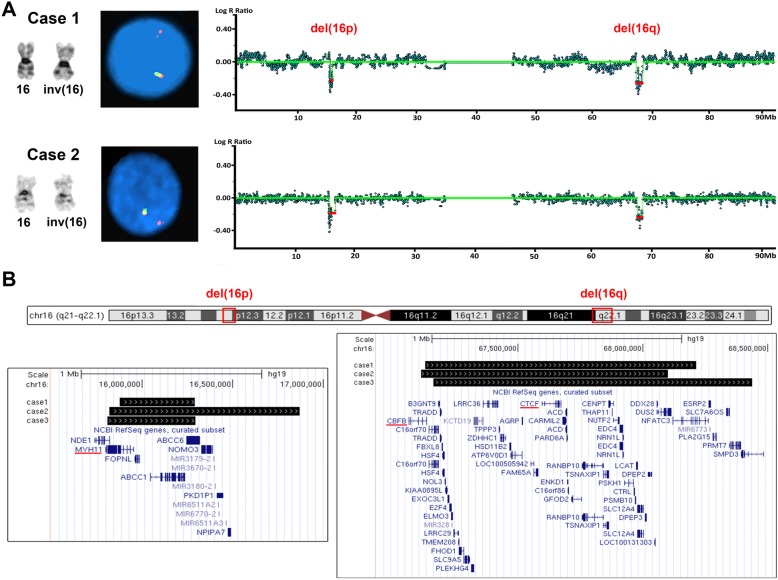 Acute myeloid leukemia with inv(16)(p13.1q22) and deletion of the 5’MYH11/3’CBFB gene fusion: a ...