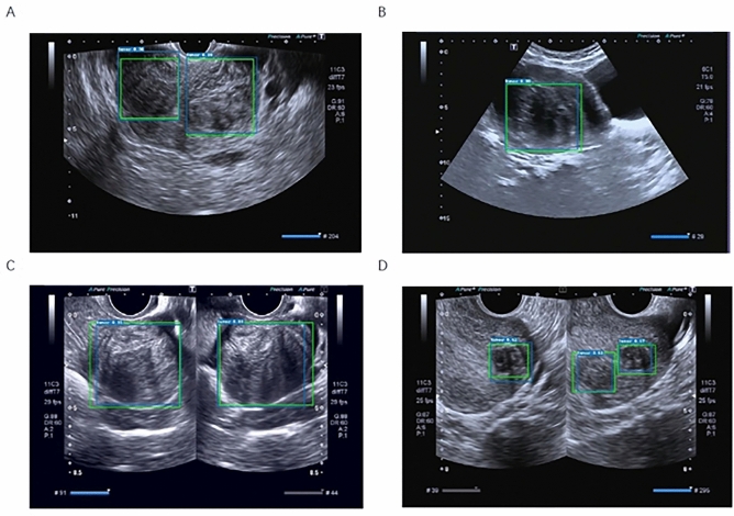 Artificial intelligence-aided method to detect uterine fibroids in ultrasound images: a ...