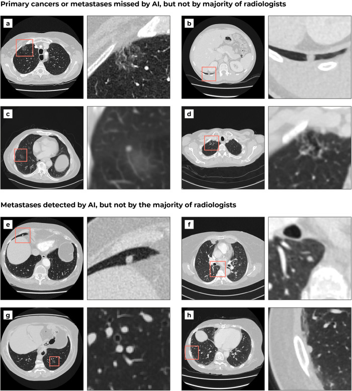 Deep learning for the detection of benign and malignant pulmonary nodules in non-screening chest ...