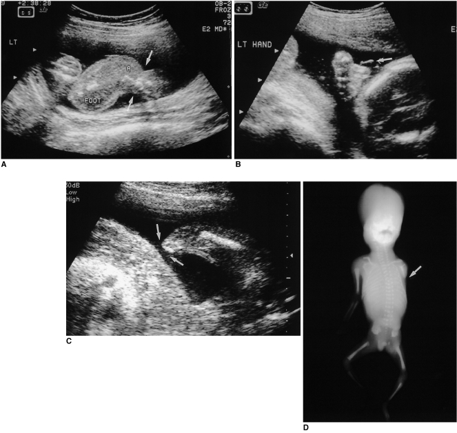 Prenatal Sonographic Diagnosis Of Focal Musculoskeletal Anomalies Pmc