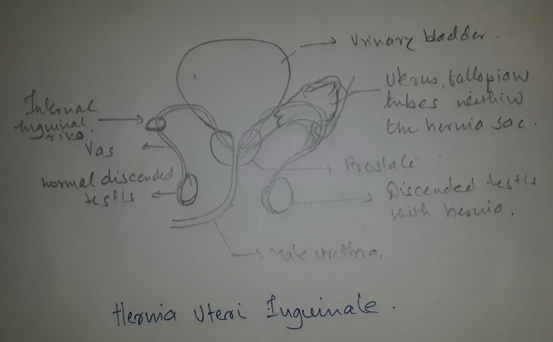 Persistent Müllerian Duct Syndrome (PMDS): a Rare Anomaly the General Surgeon Must Know About - PMC