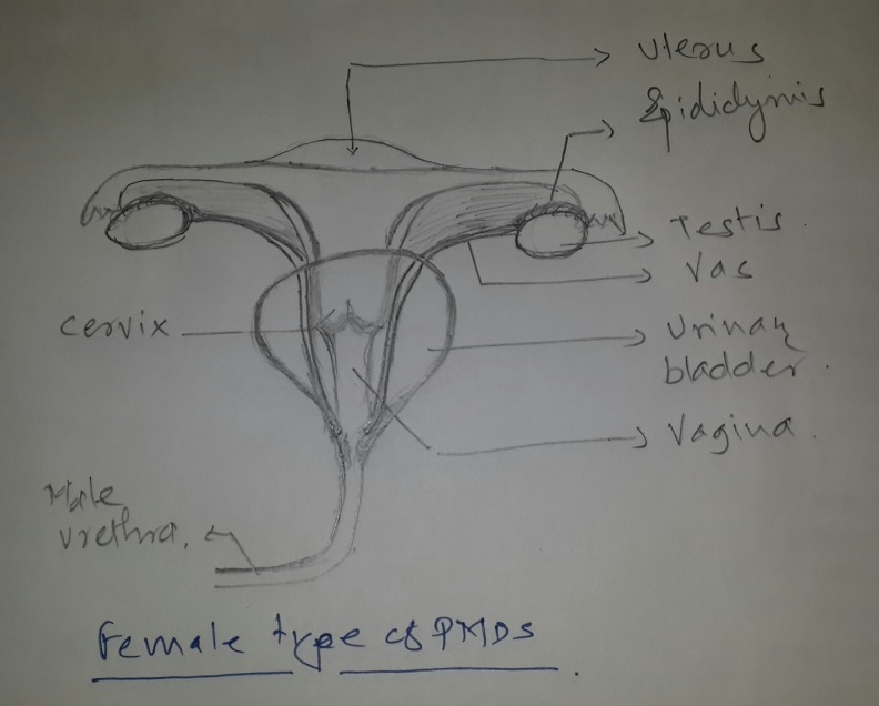 Persistent Müllerian Duct Syndrome (PMDS): a Rare Anomaly the General Surgeon Must Know About - PMC