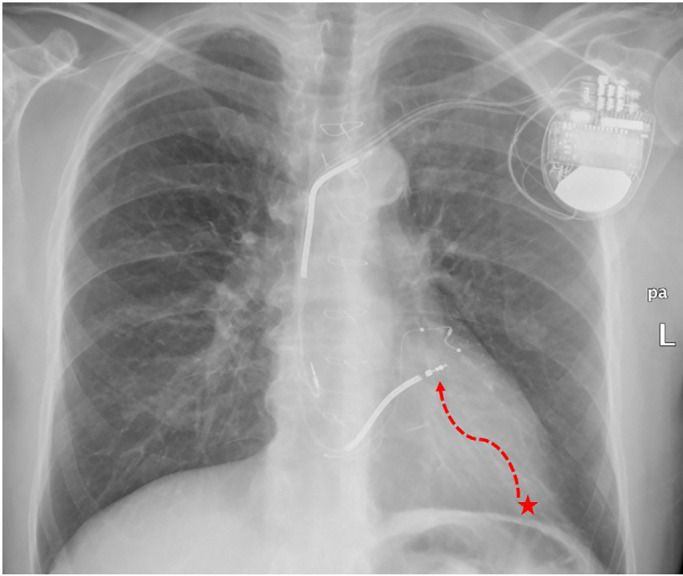 Paradoxical Pacing Spikes During A Wide Complex Tachycardia In