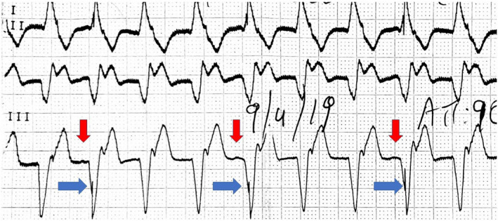 Paradoxical Pacing Spikes During A Wide Complex Tachycardia In