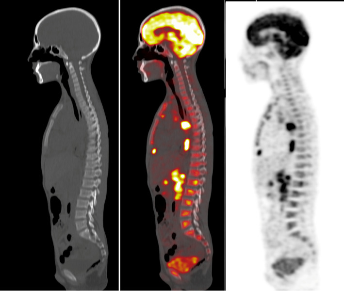 18F-FDG PET/CT versus bone marrow biopsy in detecting bone marrow infiltration in initial ...