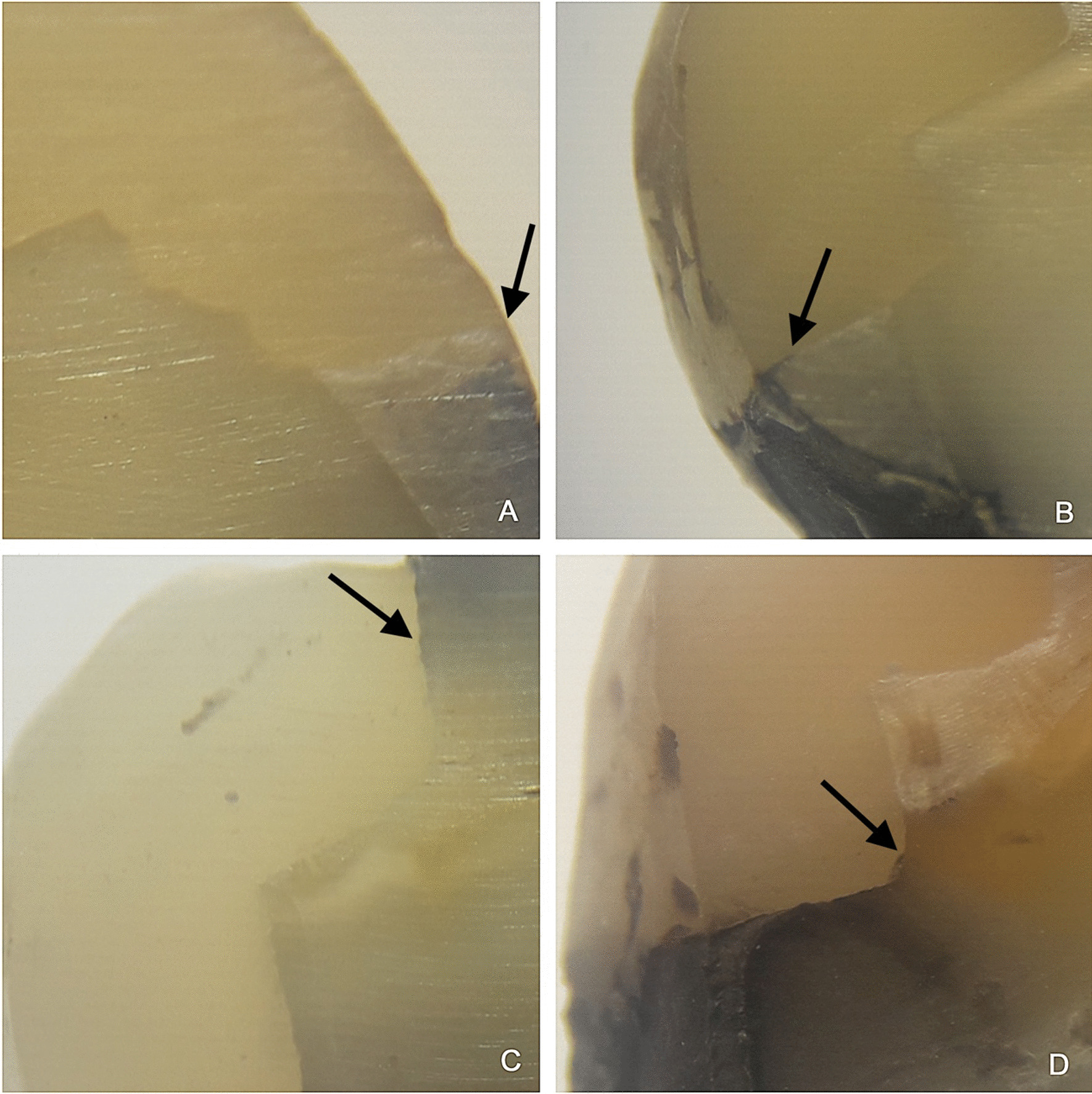 Microleakage In Class Ii Restorations Of Two Bulk Fill Resin Composites And A Conventional