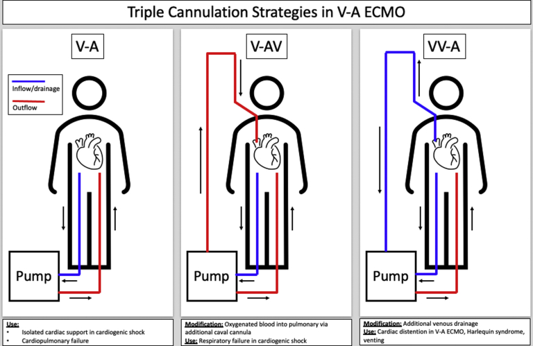 Acquired tracheomalacia due to aortic aneurysm managed with venopulmonary extracorporeal ...