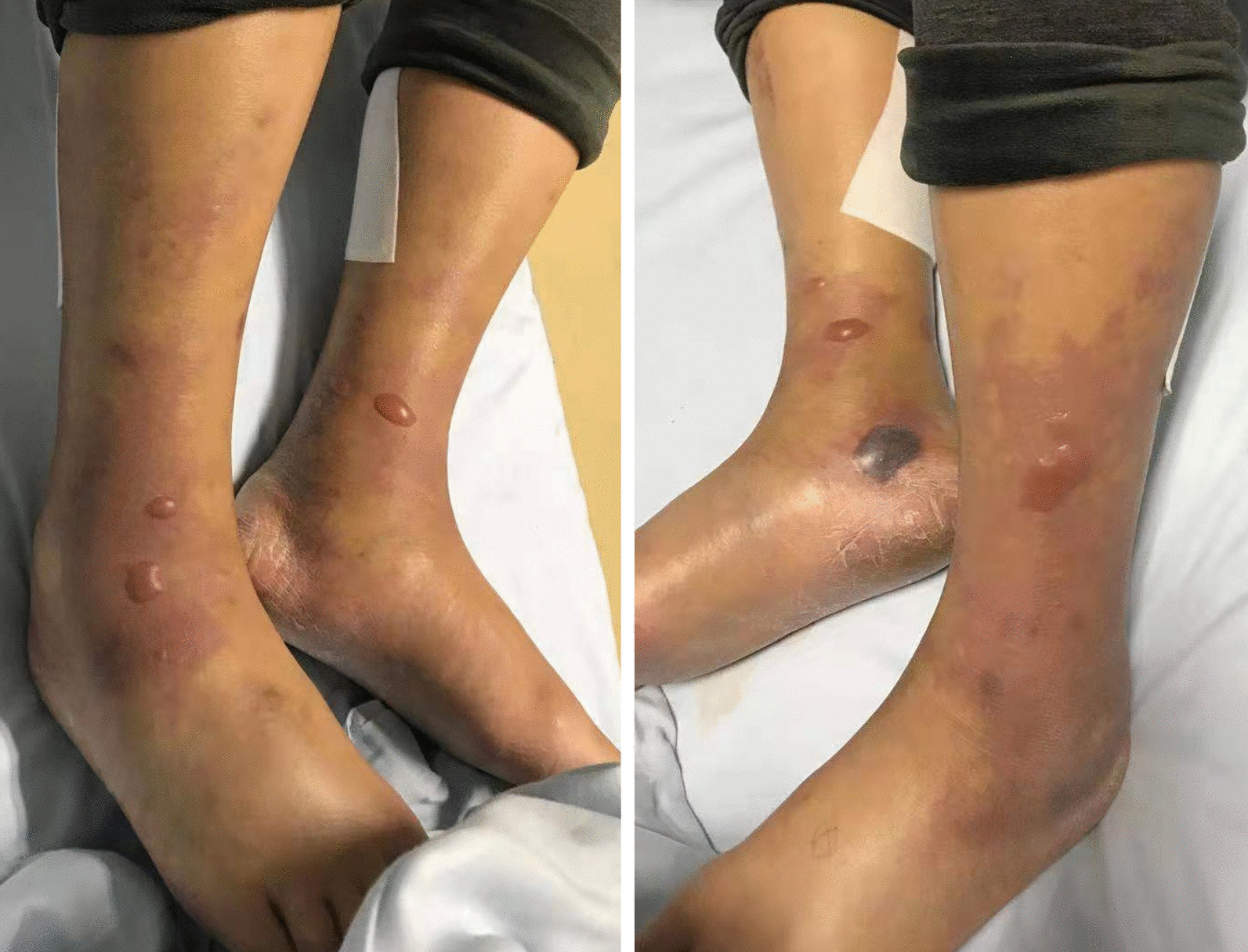 Vibrio vulnificus necrotizing fasciitis with sepsis presenting with pain in the lower legs in ...