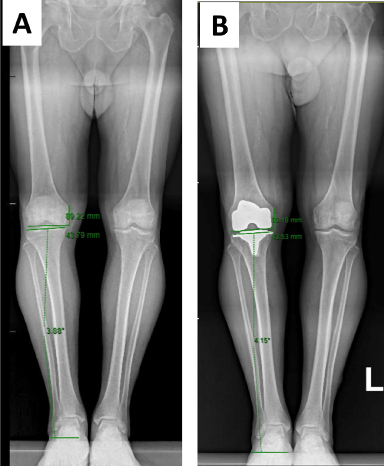 Better restoration of joint line obliquity in tibia first restricted kinematic alignment versus ...