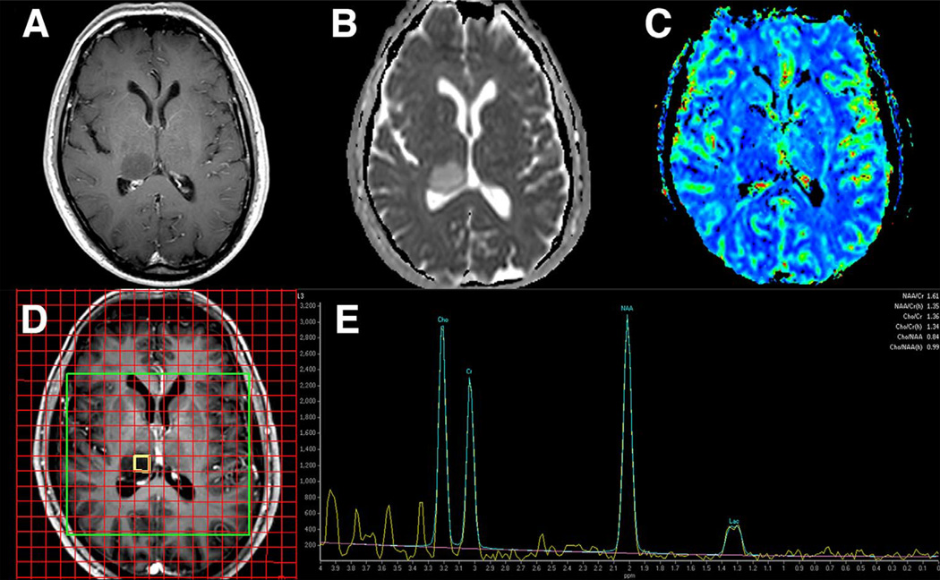 Continuing Education: Multi-modality Brain Tumor Imaging – MRI, PET, and PET/MRI - PMC