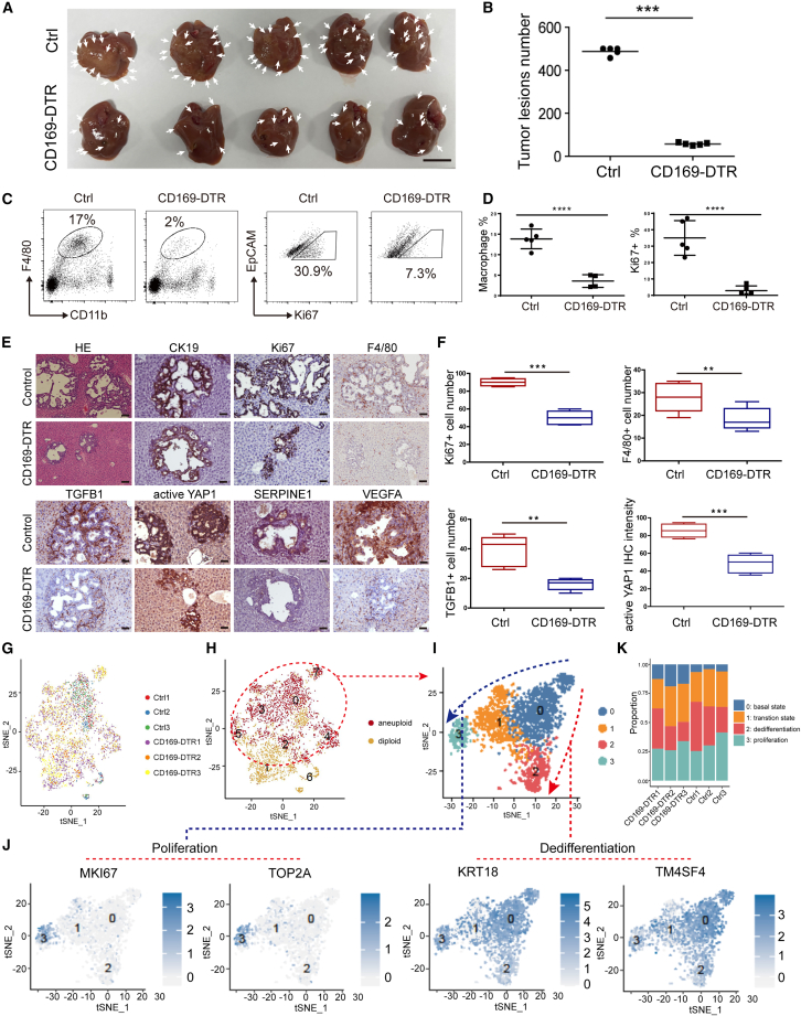 Multiple-omics analysis reveals a dedifferentiation-immune loop in intrahepatic ...