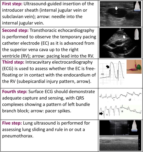 Temporary transvenous pacing guided by the combined use of ultrasound ...