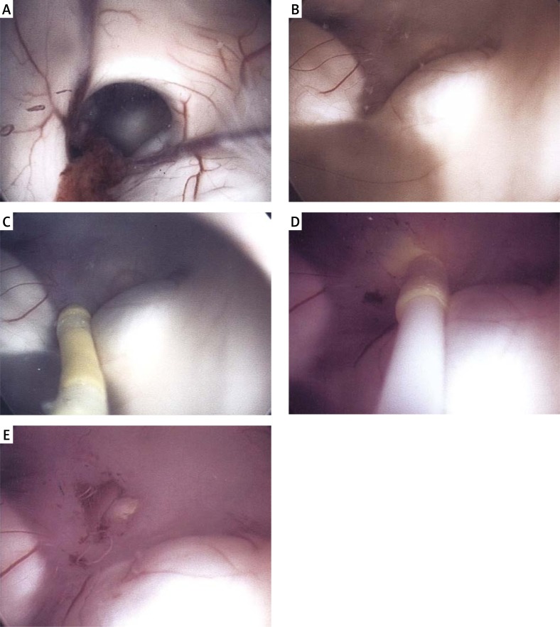 Endoscopic Third Ventriculostomy Effectiveness Of The Procedure For