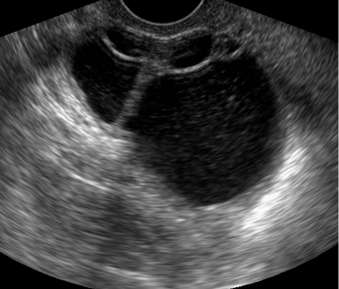 Ultrasonography Of Ovarian Masses Using A Pattern Recognition Approach