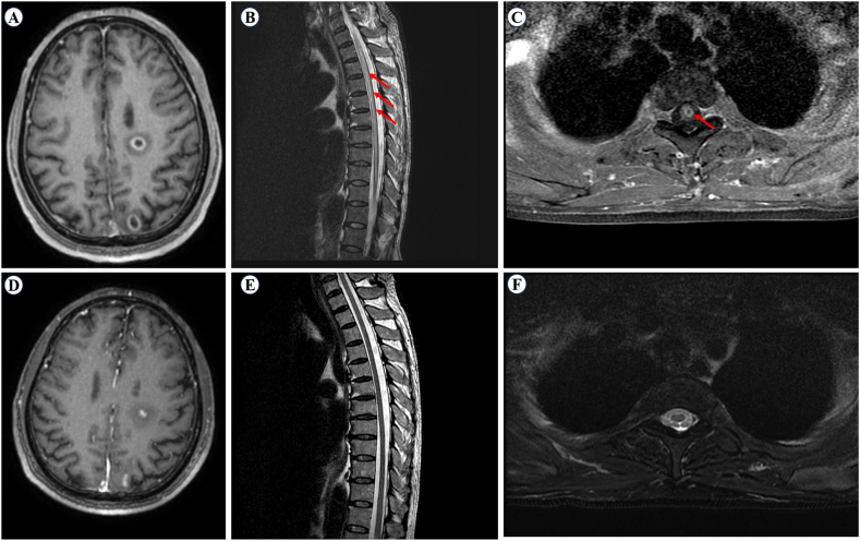 Intramedullary spinal cord abscess due to disseminated hypermucoviscous Klebsiella pneumoniae ...