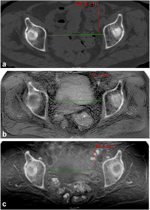 MRI-based pseudo-CT sequences as a radiation-free alternative to CT for obstetric pelvimetry: a ...