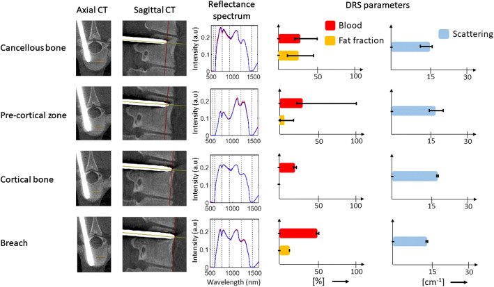 Diffuse reflectance spectroscopy for breach detection during pedicle screw placement: a first in ...