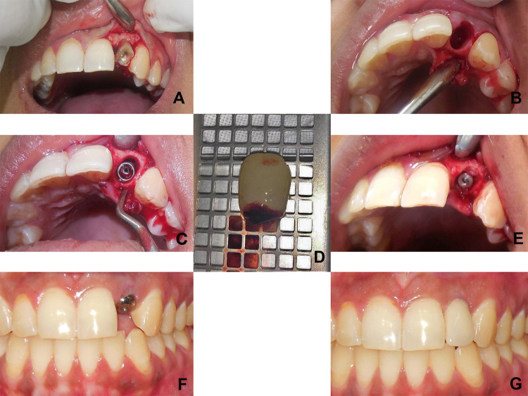 Vertical Bone Implant Contact Around Anterior Immediate Implants and Their Stability After Using ...