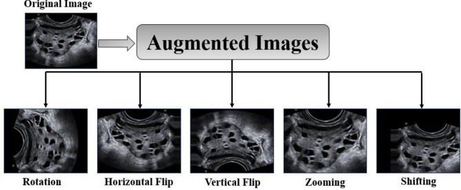 CystNet: An AI driven model for PCOS detection using multilevel ...