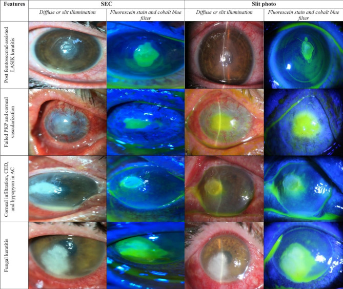 Clinical evaluation of corneal ulcer with a portable and smartphone ...