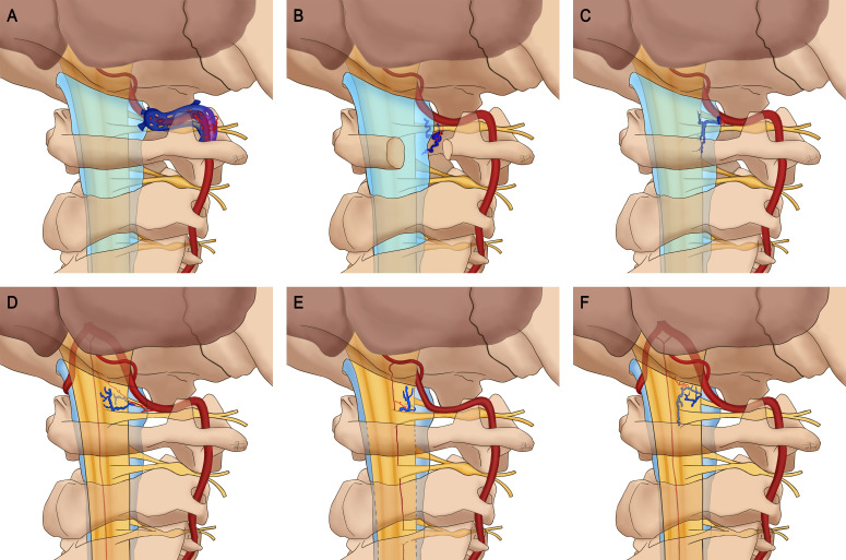 Clinical features, treatment strategies and outcomes of craniocervical junction arteriovenous ...