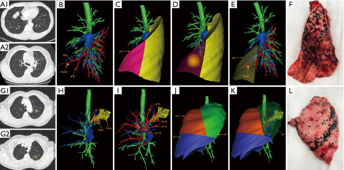 Three-dimensional computed tomography angiography and bronchography combined with three ...