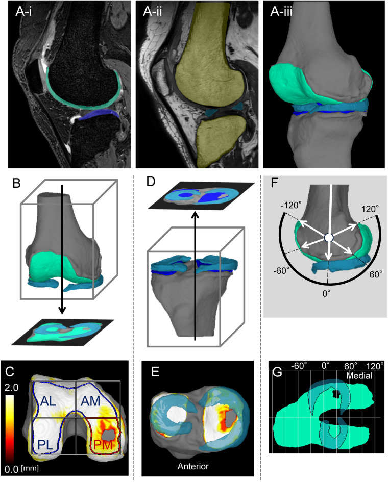 Femoral cartilage defects initiate from medial meniscus extrusion or tibial cartilage lesions ...