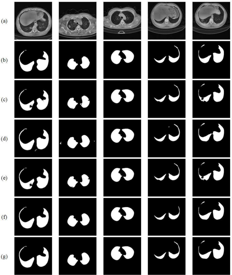 Study on lung CT image segmentation algorithm based on threshold-gradient combination and ...