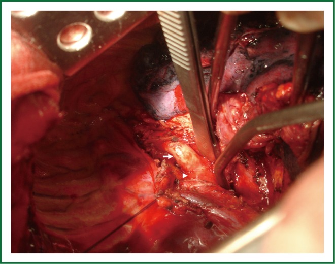 Aberrant right subclavian artery in video-assisted thoracoscopic esophagectomy - PMC