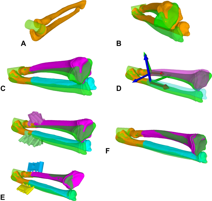 Quantification of Malalignment and Corrective Osteotomies in Patients With Malunion After ...