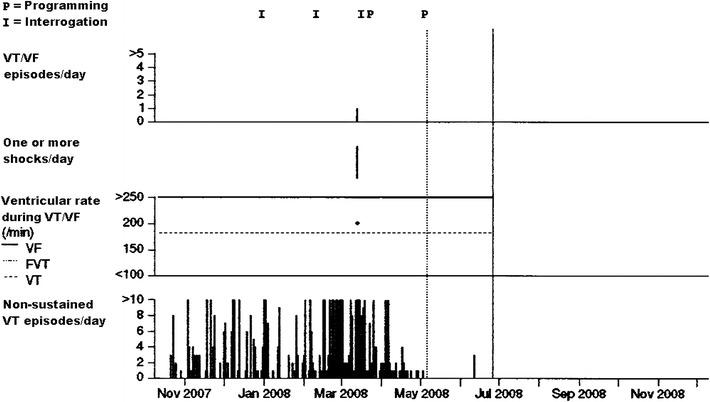 Left cardiac sympathetic denervation for the management of life-threatening ventricular ...