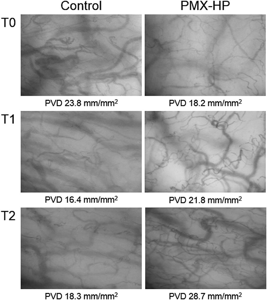 Effects of endotoxin adsorber hemoperfusion on sublingual microcirculation in patients with ...