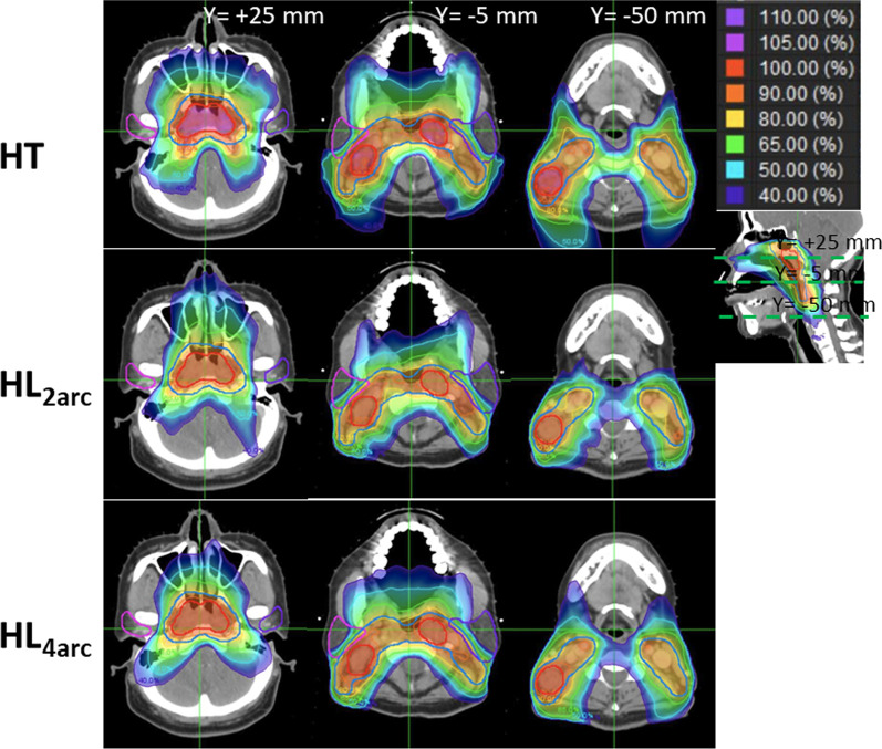 Dosimetric comparison between VMAT plans using the fast-rotating O-ring linac with dual-layer ...