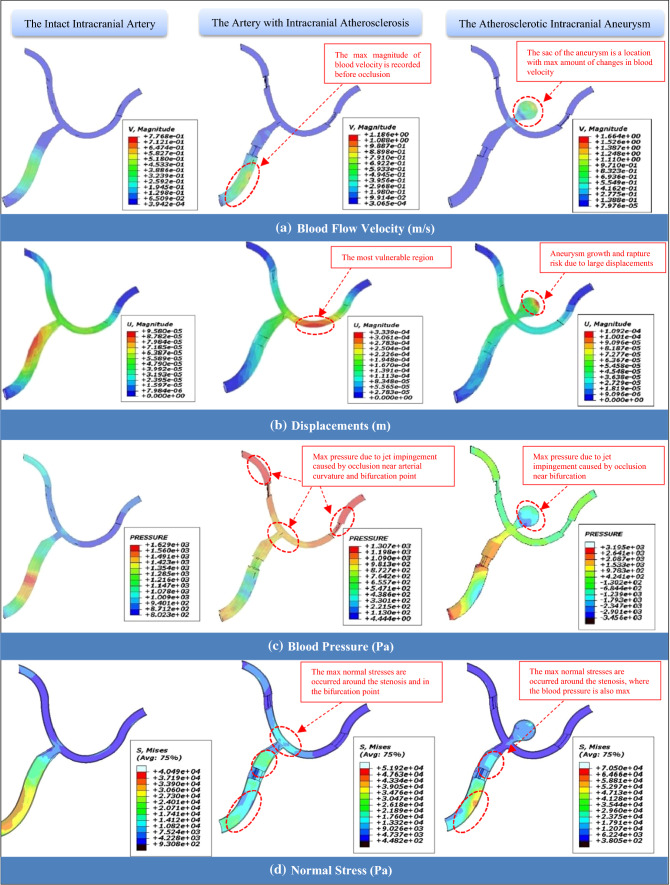 Fluid–structure interaction (FSI) simulation for studying the impact of atherosclerosis on ...