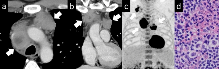 Review of clinical and diagnostic imaging of the thymus: from age-related changes to thymic ...