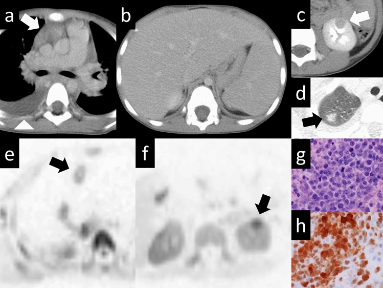 Review of clinical and diagnostic imaging of the thymus: from age-related changes to thymic ...