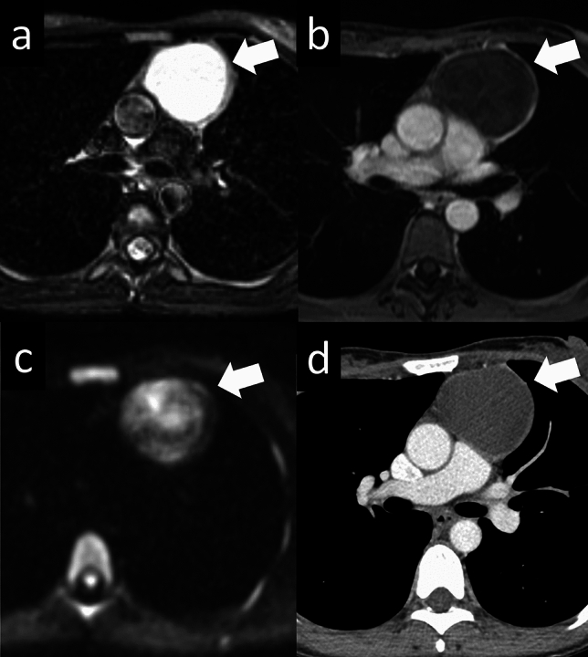 Review of clinical and diagnostic imaging of the thymus: from age-related changes to thymic ...