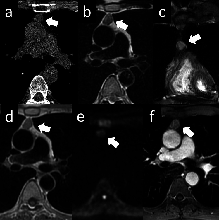 Review of clinical and diagnostic imaging of the thymus: from age-related changes to thymic ...