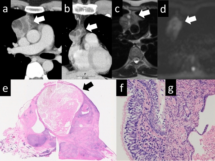 Review of clinical and diagnostic imaging of the thymus: from age-related changes to thymic ...