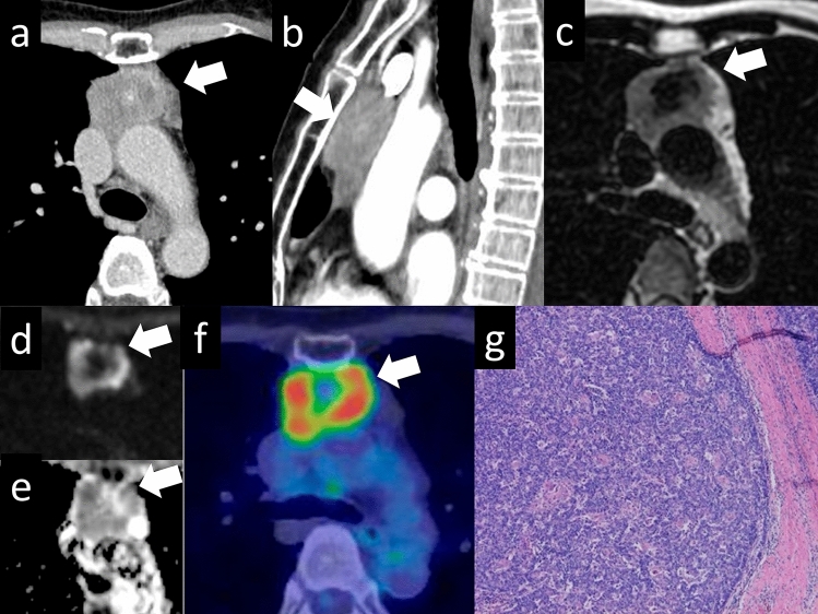 Review of clinical and diagnostic imaging of the thymus: from age-related changes to thymic ...